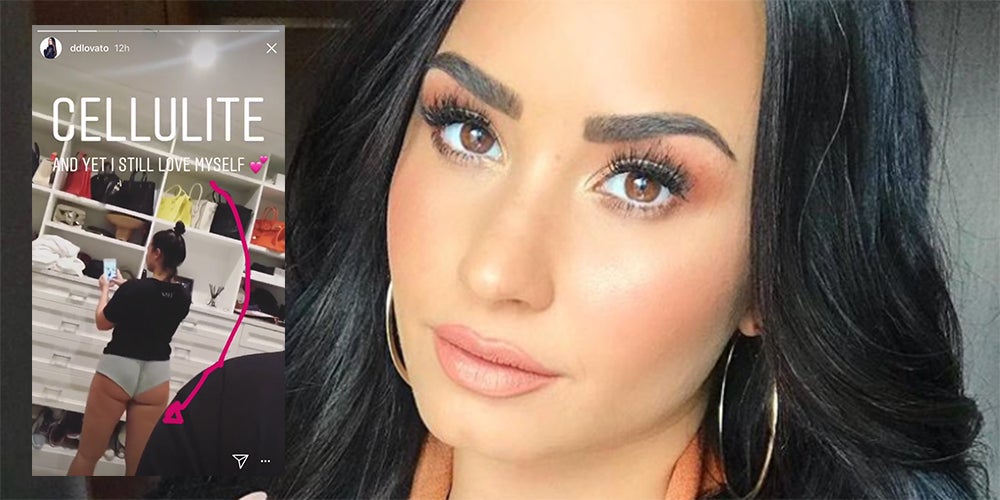 Demi Lovato Stretch Marks