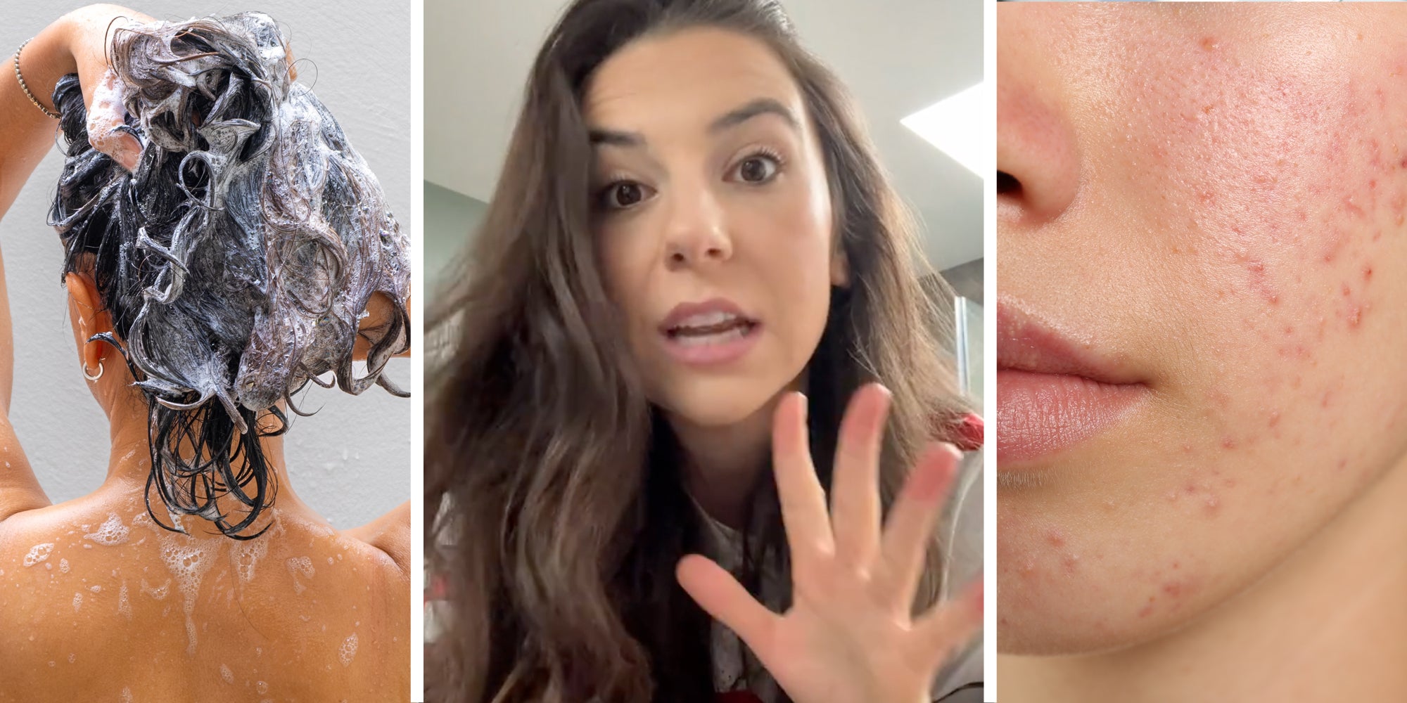 Can This Common Ingredient In Your Shampoo Cause Breakouts